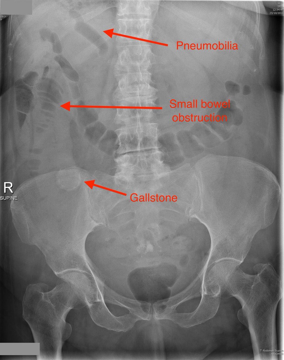 Gall bladder stone with obstruction – Surgery MCQS